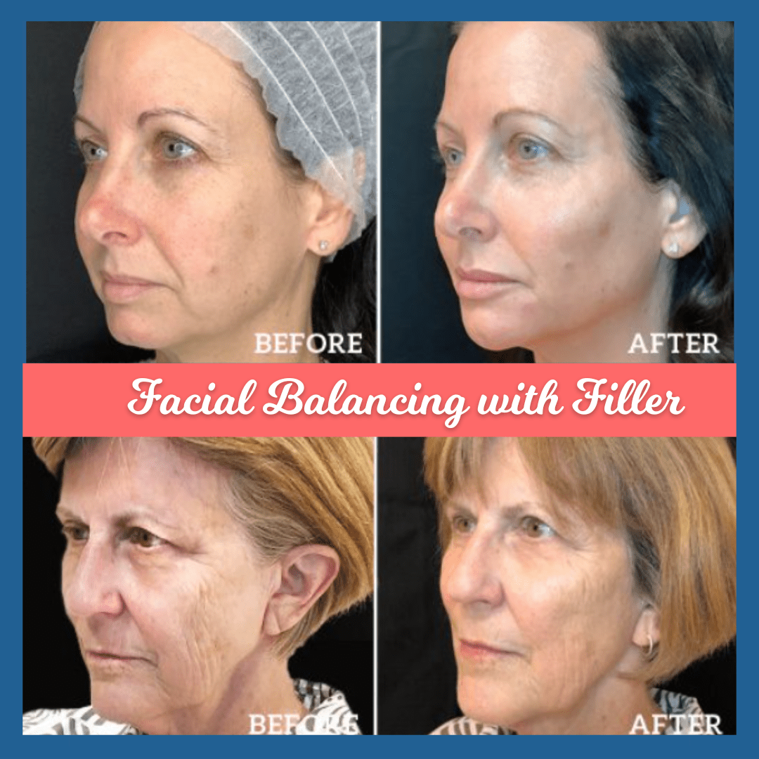 Facial Balancing with Dermal Filler - Refinery Skin Clinic
